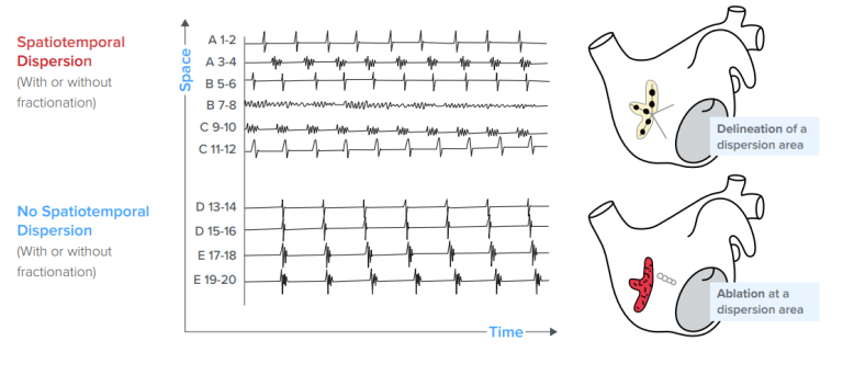AI Guided AFIB Ablation – can it become a reality? – Cardio Cypher